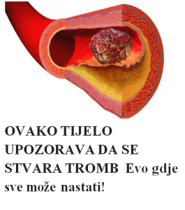 OVAKO TIJELO UPOZORAVA DA SE STVARA TROMB ⚠️ Evo gdje sve može nastati! – TOP RECEPTEKA